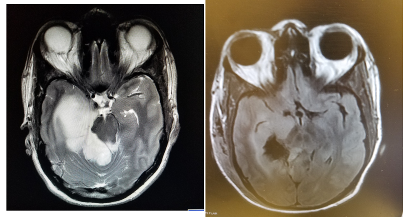 The Before and After MRIs – Your Hand in Mind